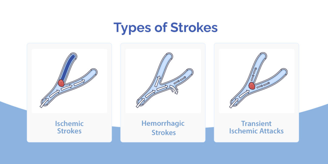 Early Signs of a Stroke | Village Caregiving